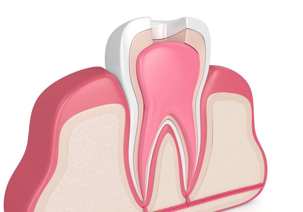How Does a Cavity Lead to Root Canal Treatment? | Indiana